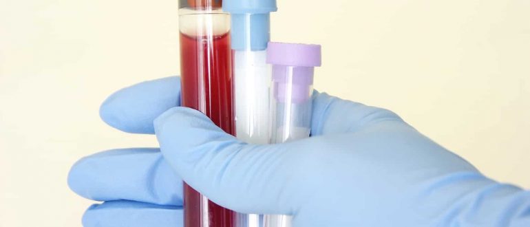 Homocysteina – co to jest, badanie, norma. Jak przygotować się do ...