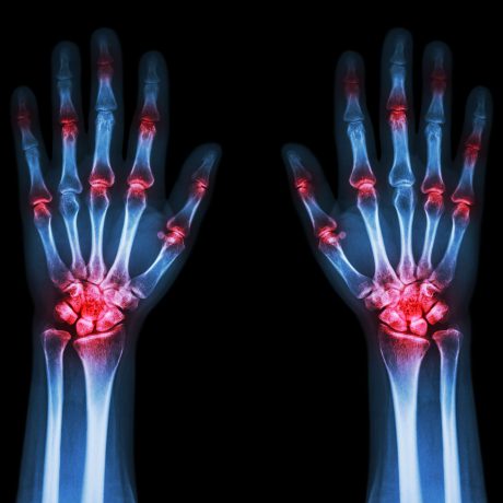 Zesztywniające zapalenie stawów kręgosłupa (ZZSK)- objawy, przyczyny i ...