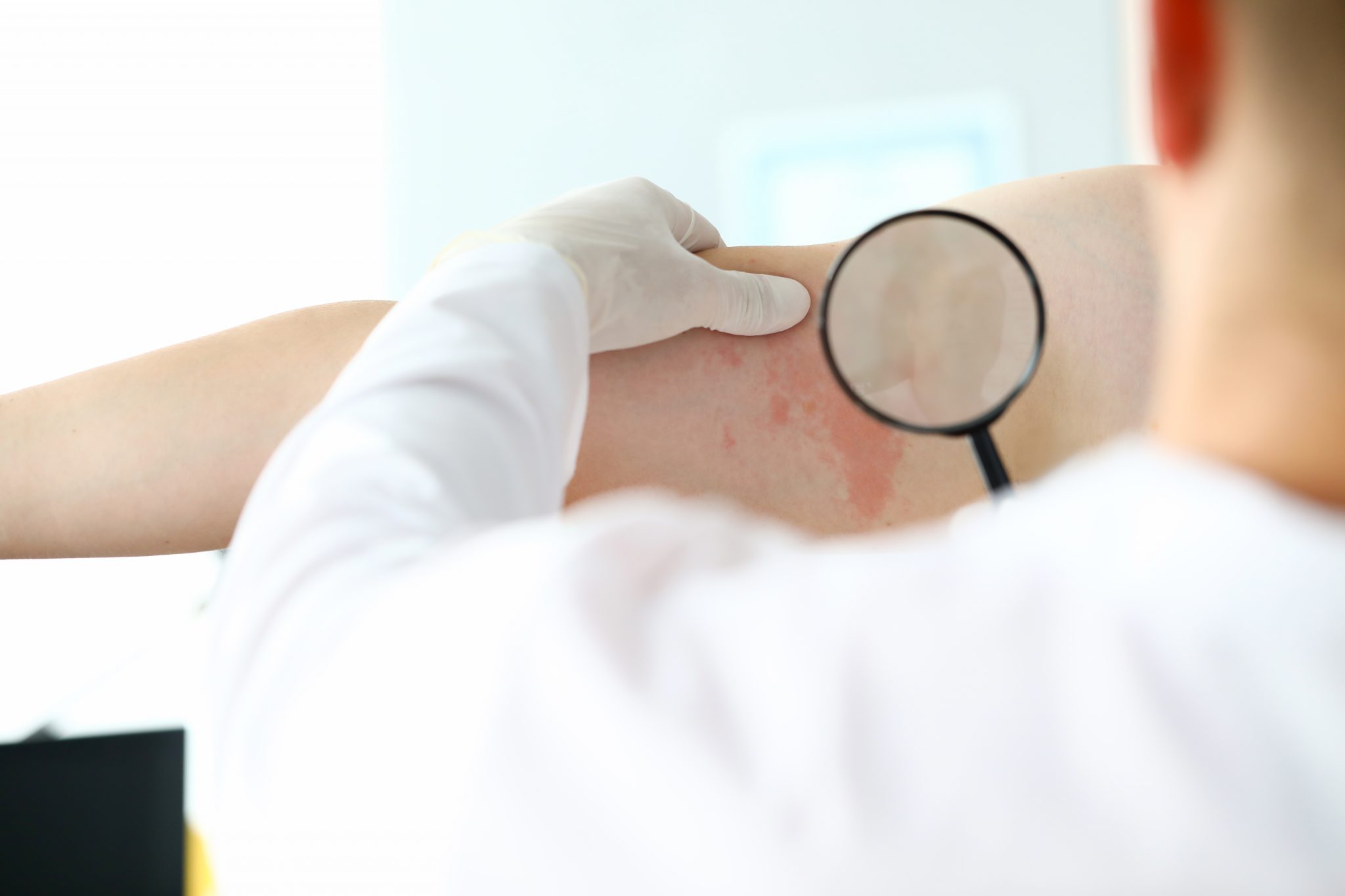 Co to jest mastocytoza? Objawy, przyczyny i sposoby leczenia – MedoVita.pl